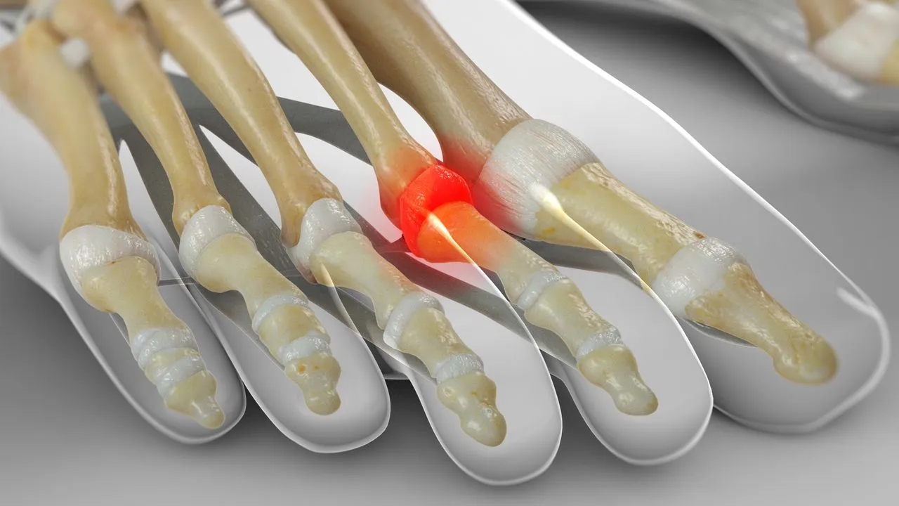 Synovitis of the Second MTPJ — Newcastle Podiatrist